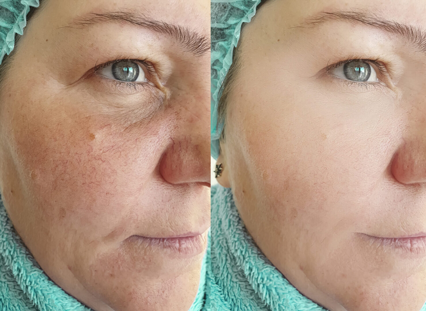 Intense Pulsed Light (IPL) Treatment, Hyperpigmentation & Age Spot ...