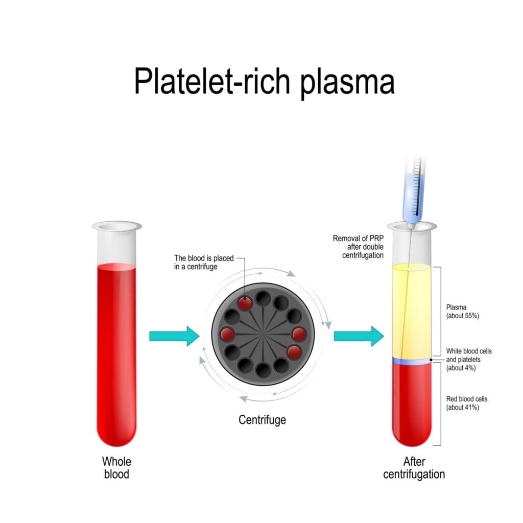 PRP Under Eye Treatment in Indianapolis | Pure Image